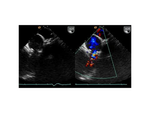 Ecocardiograma - Cendicardio